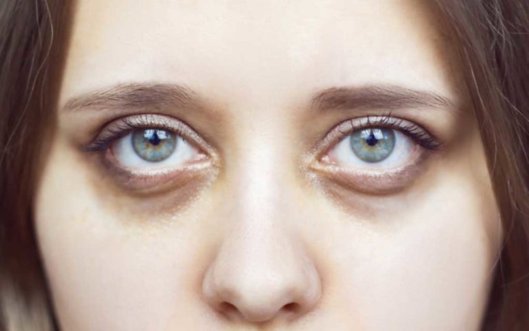 9 Ways To Treat Allergy Shiners | Go Healthier